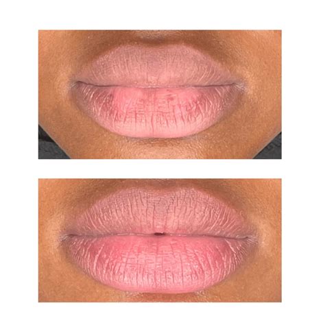 Blog Continental Skin Clinic Blog Continental Skin Clinic