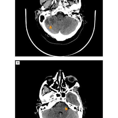 Head Computed Tomography Scan Depicting Resultant Ischemic Lesions From