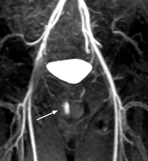 Right Cavernosal Artery Pseudoaneurysm A Gd Mra Of The Penis Showing