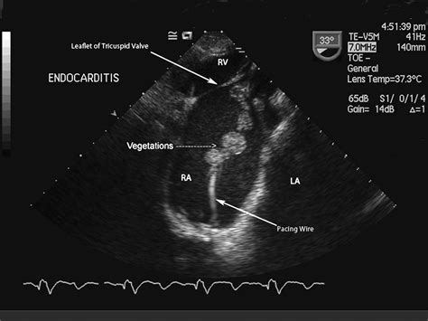 Permanent Pacemaker Wire Infective Endocarditis Emergency Medicine Journal