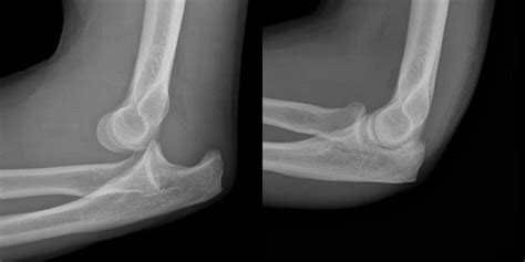 Congenital Dislocation Of The Radial Head International Limb