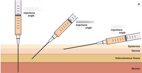 Injections Diagram Diagram Quizlet