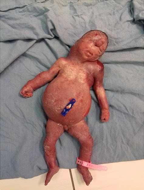Vaginally Delivered Stillborn With Cyclopia Syndrome In A Neck Present