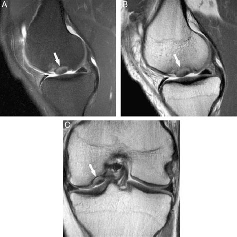 Modified International Cartilage Repair Society Classification System