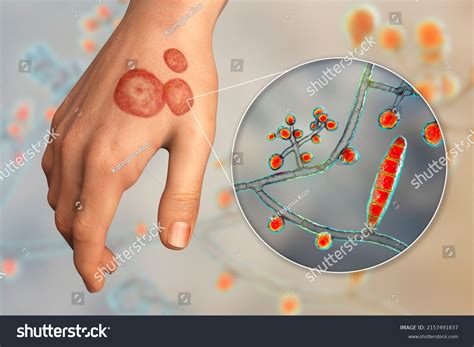 Fungal Infection On Human Hand Ringworm Stock Illustration 2157491837