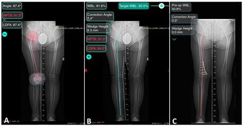 Distal Femoral Region