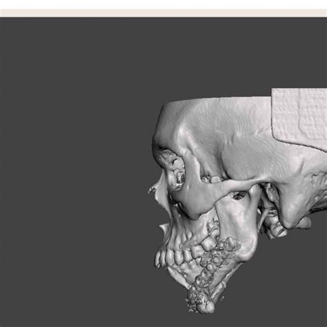 how to 3d print a dicom file step by step tutorial medimodel