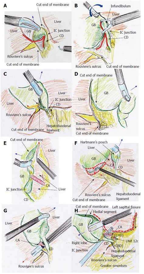 Gallbladder Infundibulum