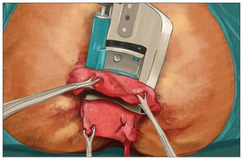 Perineal Proctectomy