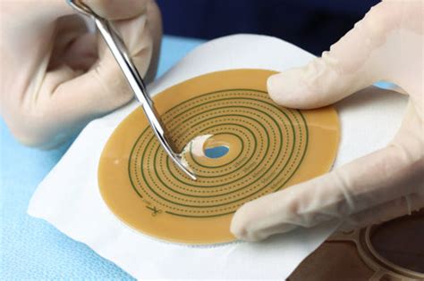 Colostomy Output Guide High Normal Low Levels And What They Mean