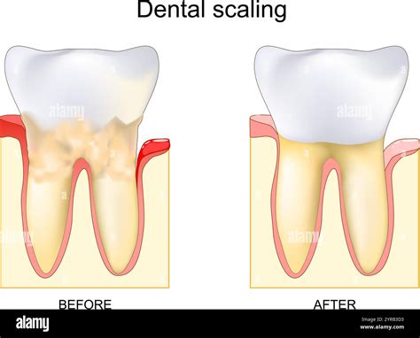 Dental Calculus Before And After Sanding Process Teeth Calculus
