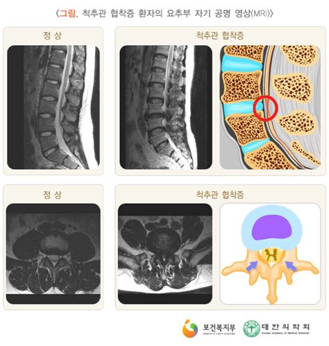 성모y마취통증의학과 디스크클리닉 척추관협착증