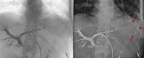 Percutaneous Cholangiogram Showing Biliary Ductal Dilatation And Subtle