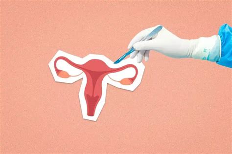 How To Perform A Transvaginal Hysterectomy Steps