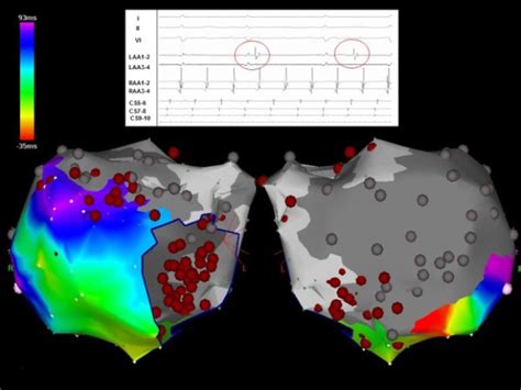 Inadvertent Isolation Of The Entire Lateral Left Atrium Note The