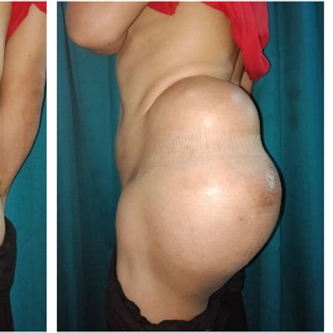 A Plain Radiograph Revealed Popcorn Calcification Download