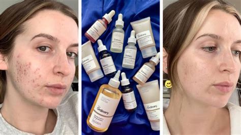 These 9 Remedies For Dark Spots Are Basically Photoshop In Real Life