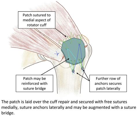Example Of Technique Used For Patch Augmentation Step 2 Download