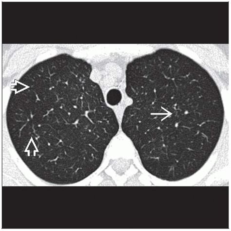 Follicular Bronchiolitis Radiology Key