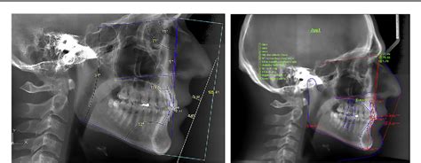 Figure 1 From The Accuracy And Reliability Of Webceph For Cephalometric Analysis Semantic Scholar