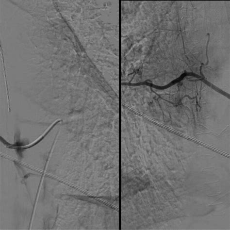 Avm Classification By Yakes Et Al 9 Download Scientific Diagram