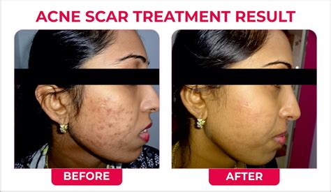 Laser For Acne And Scars Sakhiya Skin Clinic