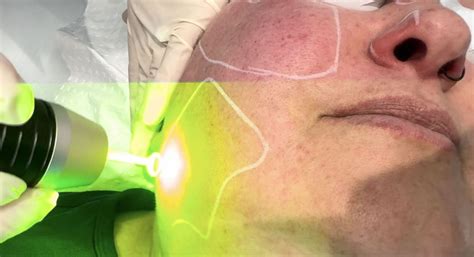 Redness And Sensitivity Skincare Laser Clinic