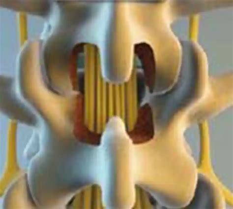 Coflex Hoplite Surgical Device And Spinal Implant Distributor