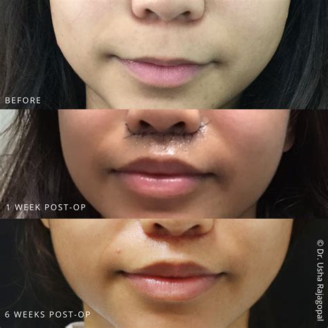 Bullhorn Lip Lift Usha Rajagopal Md