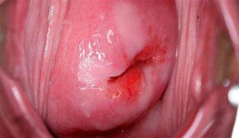 宫颈炎图片宫颈炎症状表现图片大全有来医生