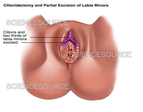 Clitoridectomy And Partial Labia Excisio Stock Image Science Source
