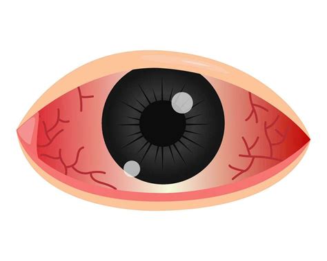 Red Eye Conjunctivitis Vector Illustration 33517806 Vector Art At Vecteezy