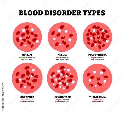 Stock Vektorgrafik „different Types Of Blood Disorder Types Anemia