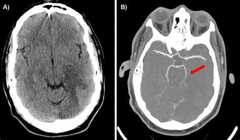 Ct Head Demonstrating Left Parieto Occipital Hypodensity With Localized