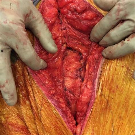 Reduction Of Hernia Content And Primary Closure Of The Defect