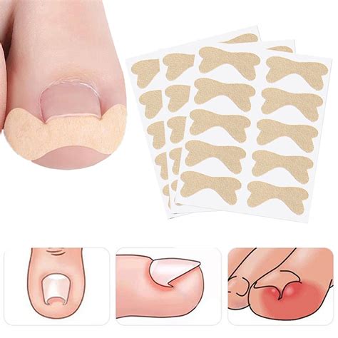 Ingrown Toenail Treatment Ingrown Toenail Corrector Strips Professional