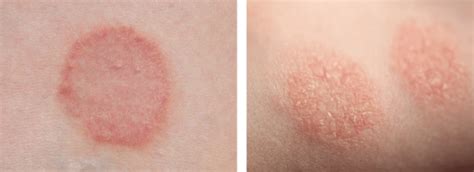 Ringworm Oorzaak En Tips Sproet