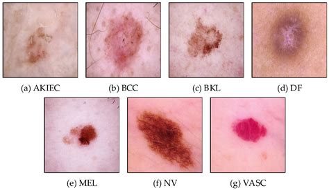 Electronics Free Full Text A Skin Disease Classification Model