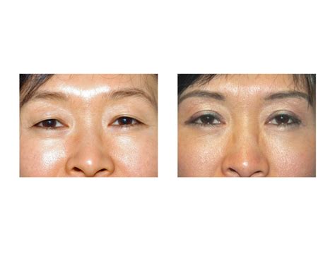 Double Eyelid Surgery With Epicanthoplasty Explore Plastic Surgery