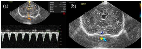 Duplex Power Doppler Echoencephalography A Through The Anterior