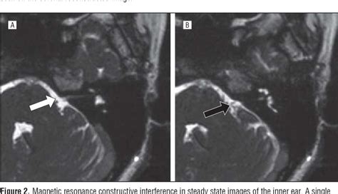 Mri Of Inner Ear Canal