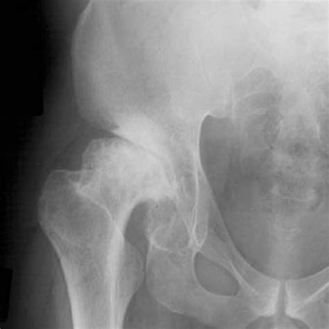 Hip Resurfacing A Suitable Option For Those With Mild Ddh Crowe I And