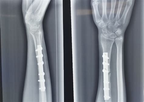Orthopedic And Fracture Clinic In San Jose Dr Pamela Mehta