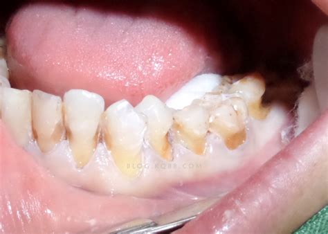 很不容易见到的全口牙颈部环形龋 白驹的博客 Kq88口腔博客