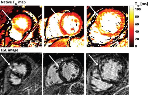 Myocardial Fibrosis Detection Without A Contrast Agent Umc Utrecht