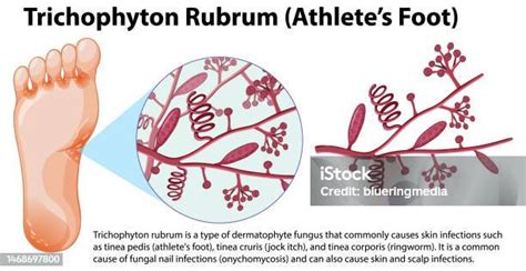 Trichophyton Rubrum Fungal Infection Stock Illustration Download