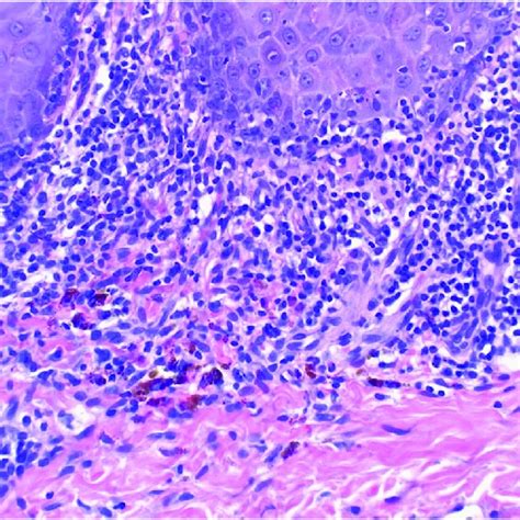 Epidermal Acanthosis Hypergranulosis With Slight Hyperkeratosis And