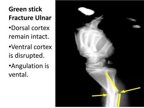 Greenstick Fractures Pptx