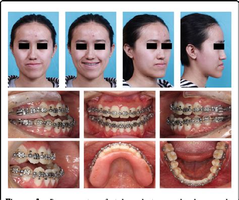 Figure 3 From Computer Assisted Planning And 3d Printed Splint