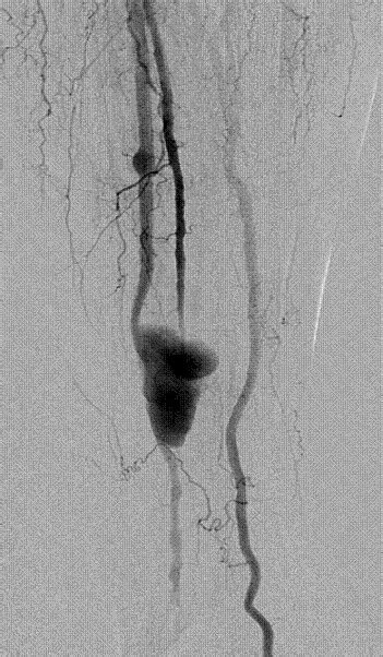Distal Subtraction Angiogram Shows A Distal Peroneal Pseudoaneurysm And